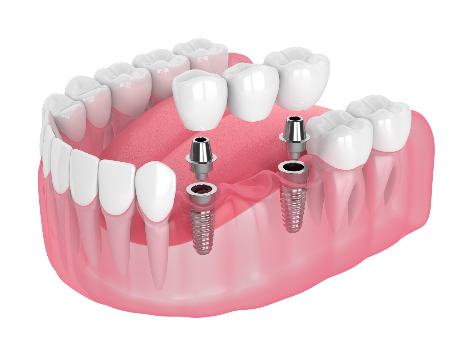 Implant-Supported Bridge Restoration in North Hollywood CA - Dentist in ...